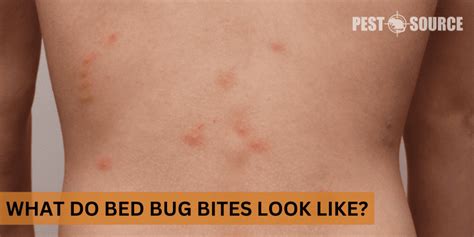What Do Bed Bug Bites Look Like Pest Source