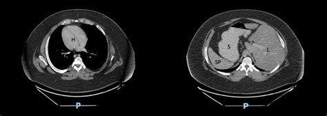 Computed Tomography Scan Of The Abdomen In Our Patient With Sit Showing Download Scientific