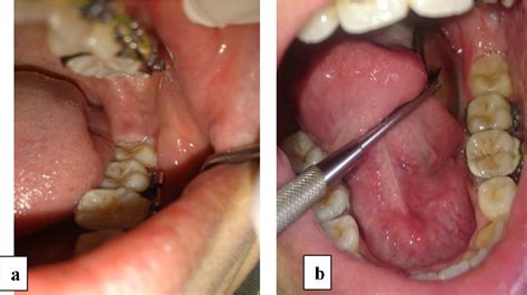 Figure 2 From Surgical Operculectomy Procedure In The Treatment Of Pericoronitis Case Reports