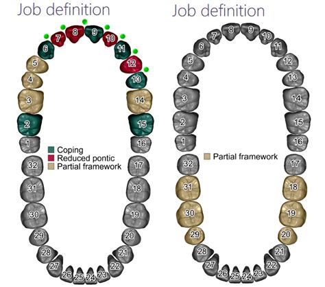 Partial Framework Design Exocad