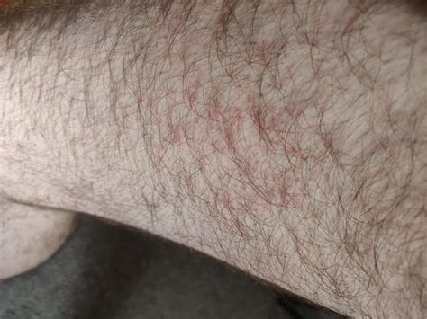 Why You Should Never Ignore A Rash On Inner Thigh Inner Thigh Inner