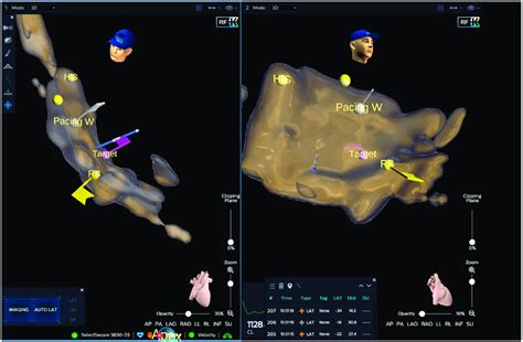 Three Dimensional Electronical Mapping To Identify Left Bundle Branch Download Scientific