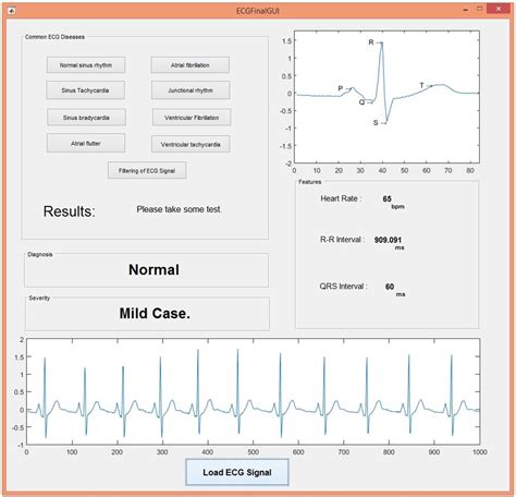 Ecg Simulation Using Matlab The Engineering Projects