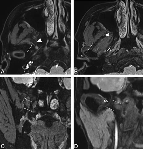 66 V3 Mandibular Branch Of Trigeminal Nerve Cranial Nerve 5 Youtube