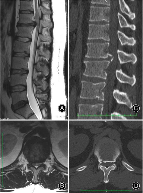 Typical Case 1 A 35‐year‐old Male Patient With Myelopathy Caused By Download Scientific