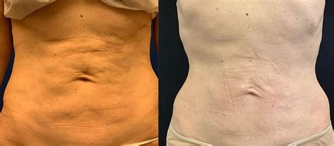 Abs And Waist Liposuction Before And After Neinstein Plastic Surgery