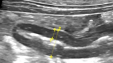 Appendicitis Ultrasound Protocol Practical Sono