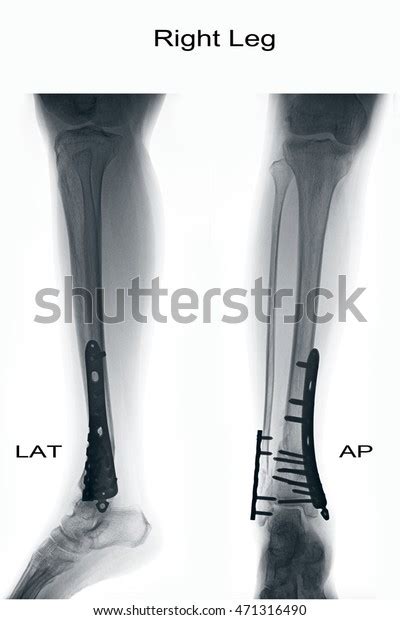 Стоковая фотография 471316490 Closed Fracture Tibia Fibula Right Leg Shutterstock