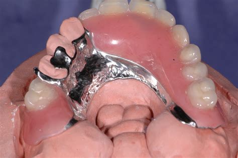 Partial Denture Fitting Process At Gemma Nock Blog