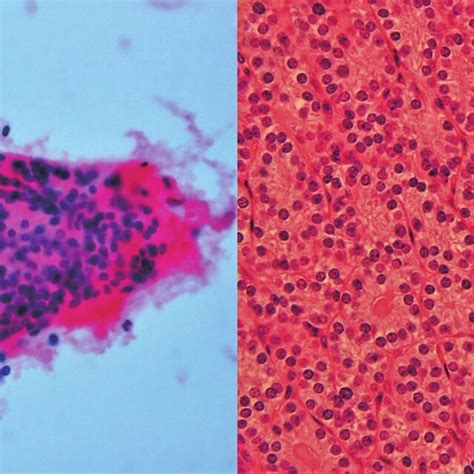 Histopathologic Examination Revealed Parathyroid Adenoma A