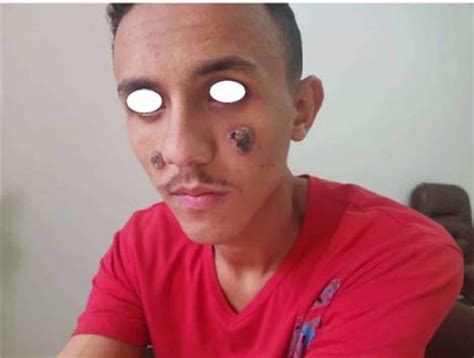 Pyodermatitis Pyostomatitis Vegetans Associated With Autoimmune Hepatitis Unreported Co