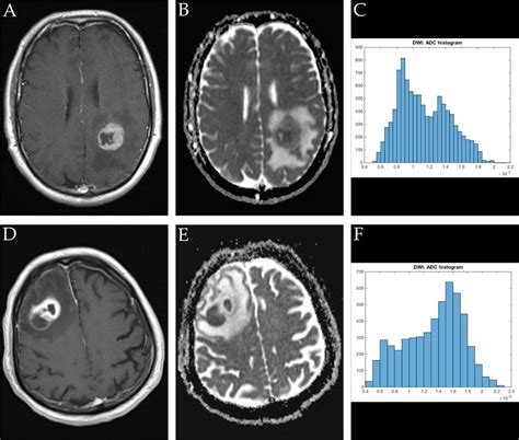 Imaging Findings And Corresponding Adc Histograms Of Morphologically