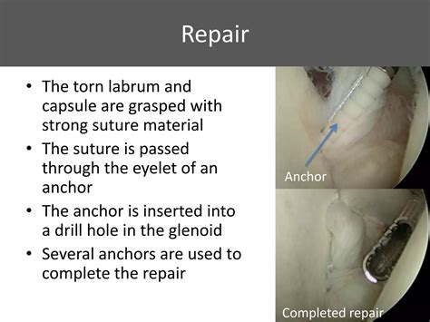 Arthroscopic Shoulder Stabilisation Patient Information Pptx