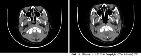Neck Computed Tomography Of The Patient On The Fifteenth Day Of