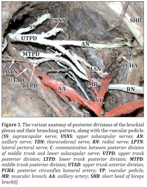 Concomitant Variations Of The Brachial Plexus And Third Part Of Axillary Artery In A Middle Aged
