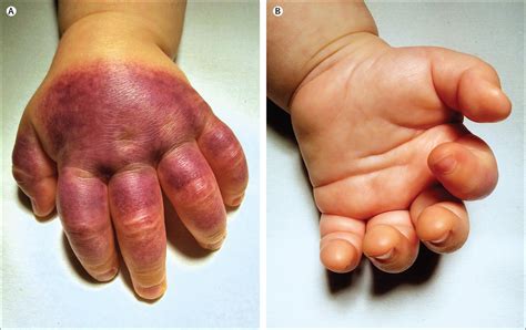 Severe Edema