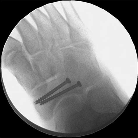 Cosm Open Reduction And Internal Fixation Of Navicular Stress Fracture With Or Without Bone Graft