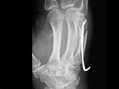 Surgical Indications And Treatment Of A Metacarpal Fracture