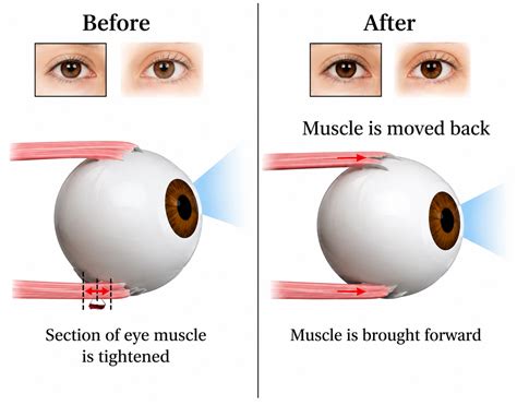 Squint Treatment In Ahmedabad Krisha Eye Hospital