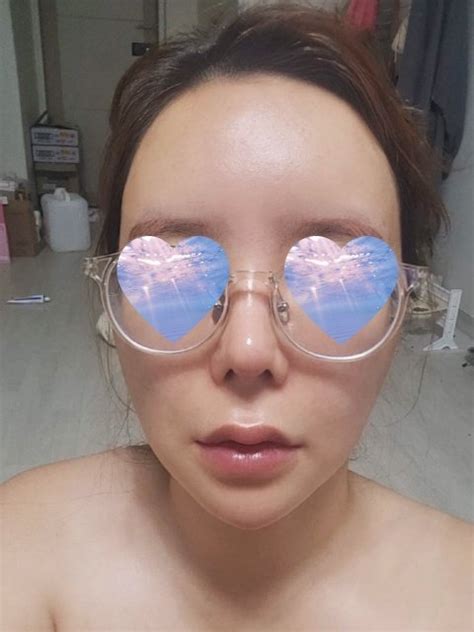 발품후기 압구정서울성형외과 강남언니 1등 성형수술and피부시술 정보앱