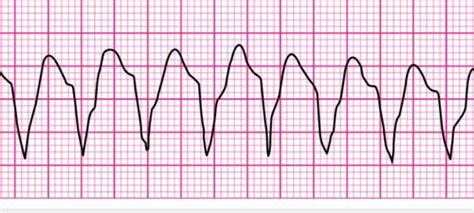 ACLS Flashcards Quizlet