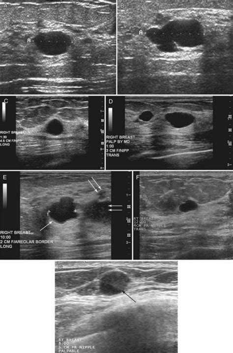 Cluster Of Cysts In Breast Ultrasound Clusterisasi
