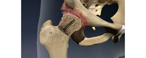 Avascular Necrosis Causes Symptoms Stages And Treatment