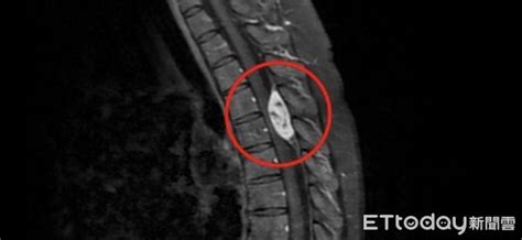 女罹罕見脊椎血管瘤「壓迫神經險癱瘓」 醫：臨床第一次遇到 Ettoday健康雲 Ettoday新聞雲