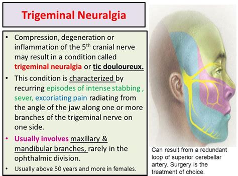 Trigeminal Neuralgia Doctors Without Waiting Rooms
