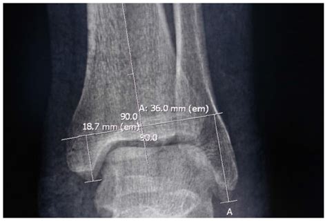 Closed Anterolateral Total Talar Dislocation A Case Report And Techni Orr
