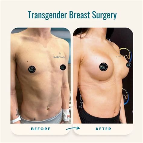 Transgender Breast Surgery Imed Medical