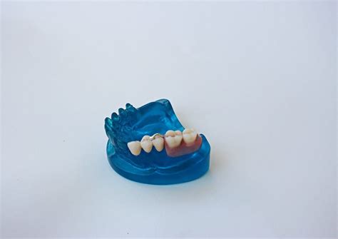 Removable Restorations Dentech Laboratory Wetherill Park Nsw