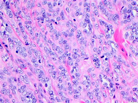 Pathology Outlines Angiosarcoma