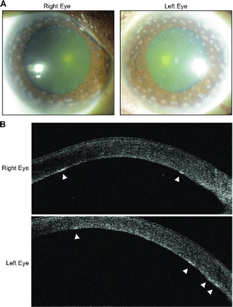 Macular Corneal Dystrophy Associated With Peripheral Descemet Membrane Download Scientific