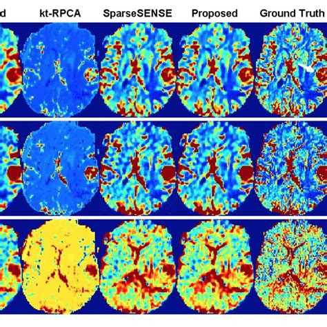 Perfusion Parameter Maps Cbf Cbv Mtt Of Subject 1 Resulting From Download Scientific