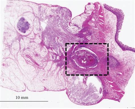 Case 2 Findings A Ct Scan Showed Penetration Of Terminal Ileum Download Scientific Diagram