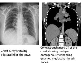 Mediastinal Lymph Nodes Anatomy Thorax Pptx