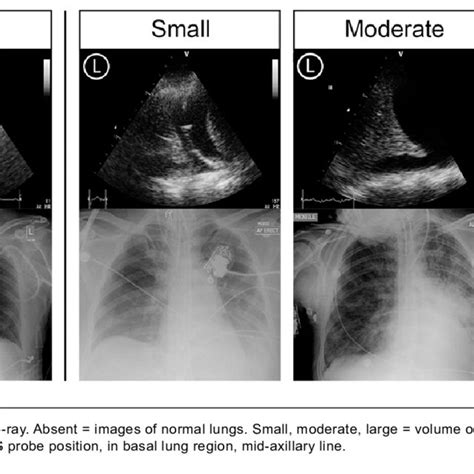 Comparison Of Lung Ultrasound Chest X Ray And Physical Examination In