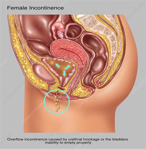 Overflow Incontinence In Female Anatomy Stock Image F031 7012 Science Photo Library