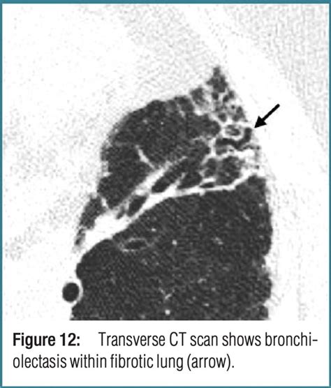 Bộ Từ Vựng Thuật Ngữ Hình ảnh Học Lồng Ngực Fleischner Fleischner Society Glossary Of Terms