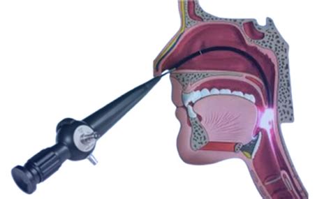 Laringoscopía Flexible Nasolaringoscopía Fibroendoscopía Laríngea