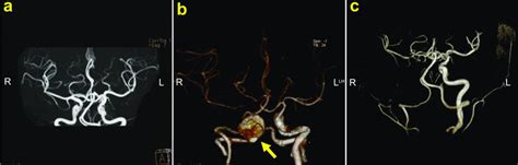 Patient 3s Pre And Postoperative Imaging Of Ica Balloon Download Scientific Diagram