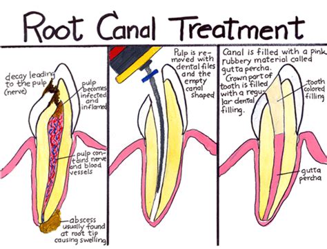 Steps In Root Canal Treatment Dentalorgcom