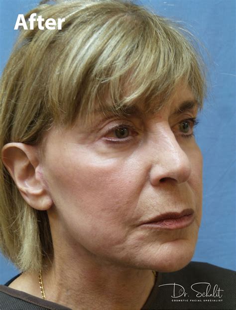 Face And Neck Lift 14 Dr Schalit Cosmetic Facial Specialist