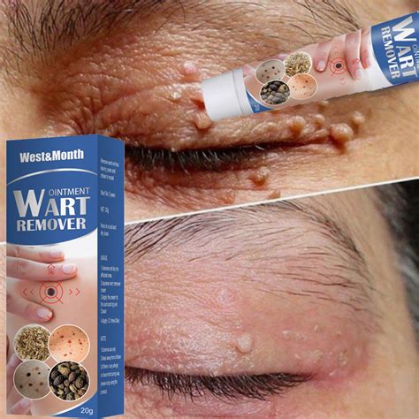 Ubat Buang Kutil Ketuat Tahi Lalat Biji Kolestrol Krim Ketuat Dan Kutil