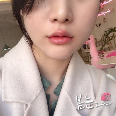 봄눈피우다의원 입술필러 유지기간은 왜 짧은 걸까요🤔 ⠀ 많은 분들이 입술필러는 유지기간이 짧다고 Facebook