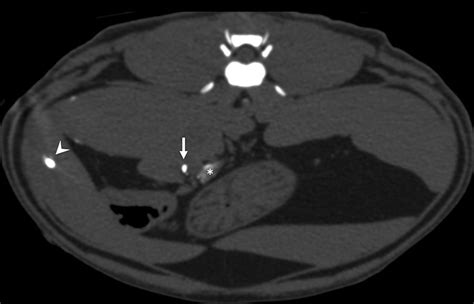 Transverse Ct Image Of The Hepatic Lymph Nodes Showing Opacification Of Download Scientific