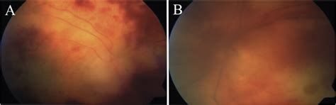 Fundus Photo Of The Right A And Left B Eyes Demonstrating Diffuse Download Scientific