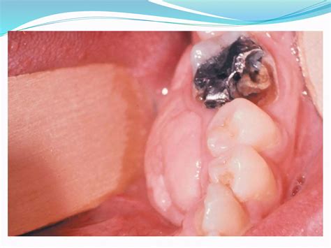 Benign Soft Tissue Tumors Ppt