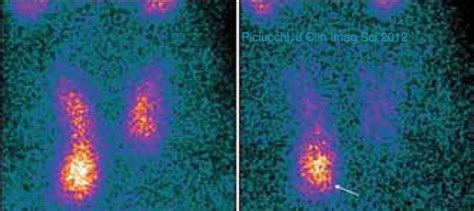 Primary Hyperparathyroidism How Not To Miss Parathyroid Tumors Gt Health